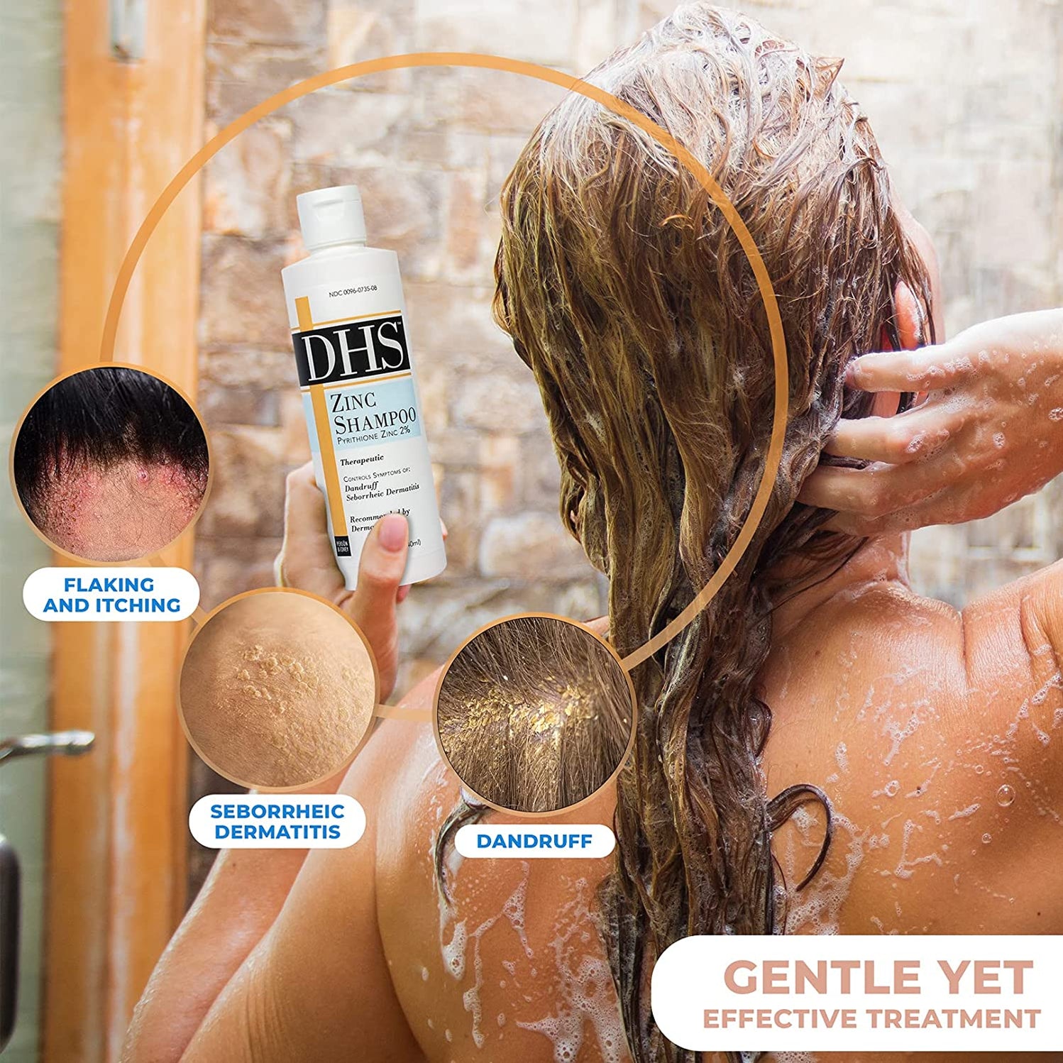 DHS Therapeutic Zinc Shampoo for Psoriasis Seborrheic Dermatitis Dandr ...