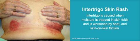 Interdry - Interdry Dressing | Mountainside Medical Equipment