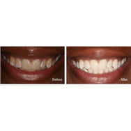 MI Paste with Recaldent 40 Gram Tube Tutti Frutti — Mountainside