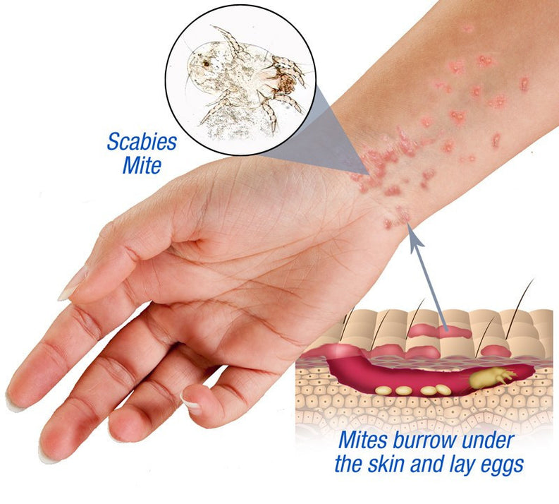 Permethrin Cream 5%, 60 gram Tube — Mountainside Medical